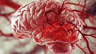44% de los pacientes de Infarto Cerebral podrían padecer secuelas ...